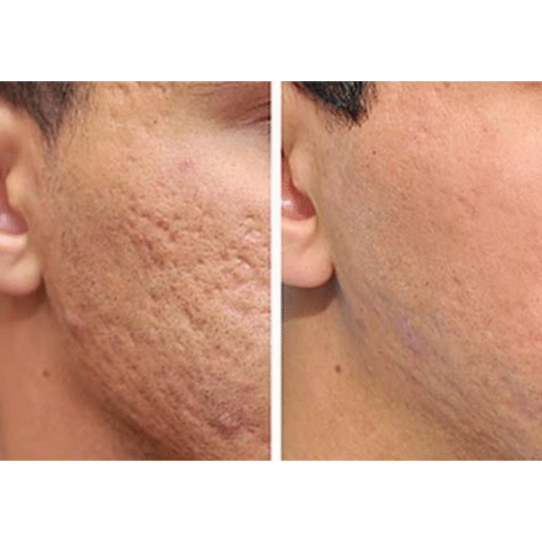 Viva – Skin Resurfacing – Mozamed Spa